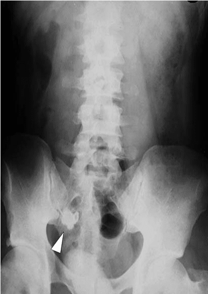 ABC Radiology Blog: Appendicitis