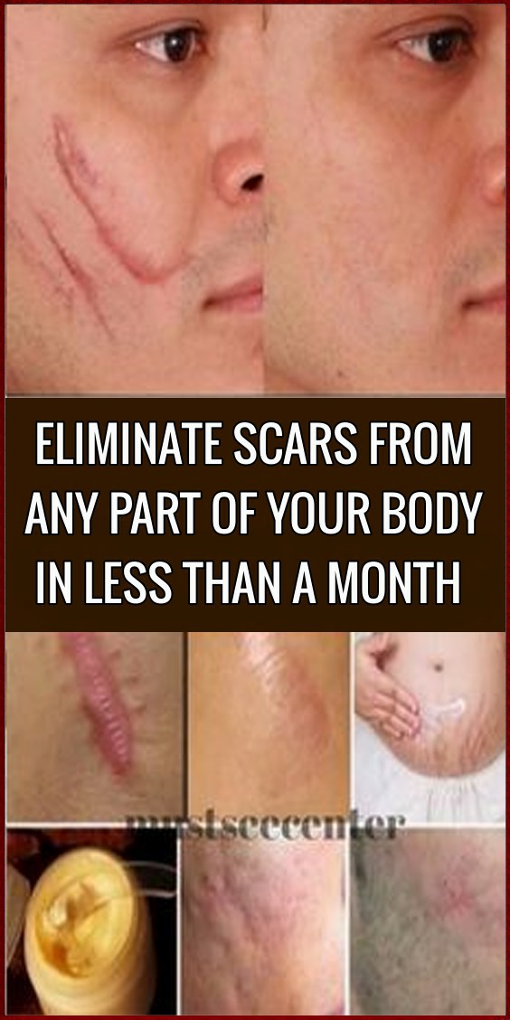 ELIMINATE SCARS FROM ANY PART OF YOUR BODY IN LESS THAN A MONTH ...