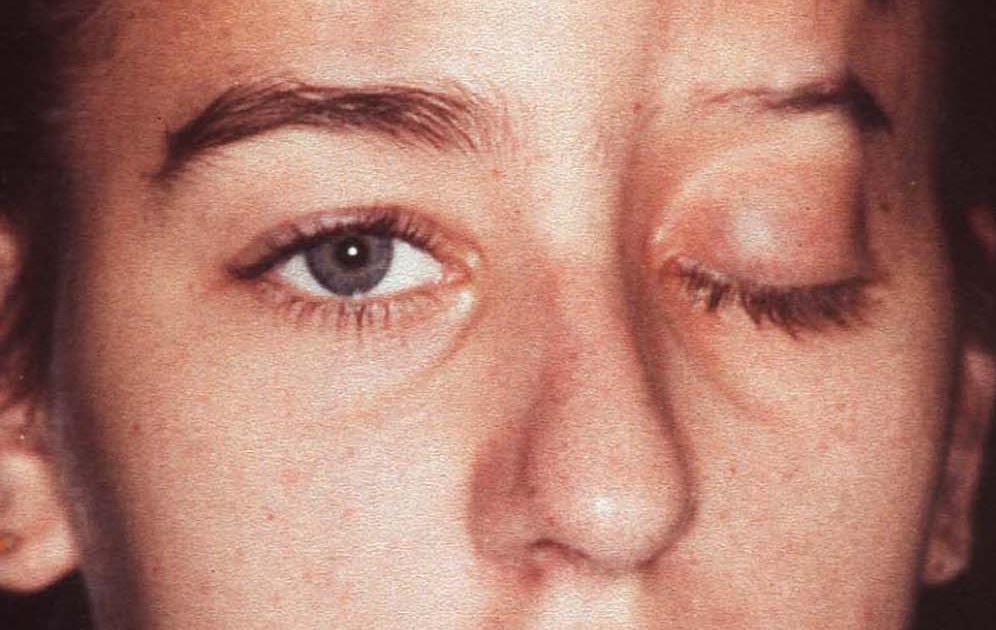 Scleroderma - Ain Health