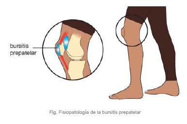 Enfoque Ocupacional en la Red.Salud y Seguridad Laboral: Bursitis ...