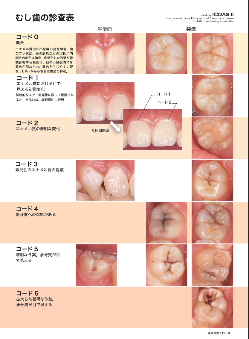 ICDAS-JHCDA: 日本ヘルスケア歯科学会のICDASに関しての取り組み