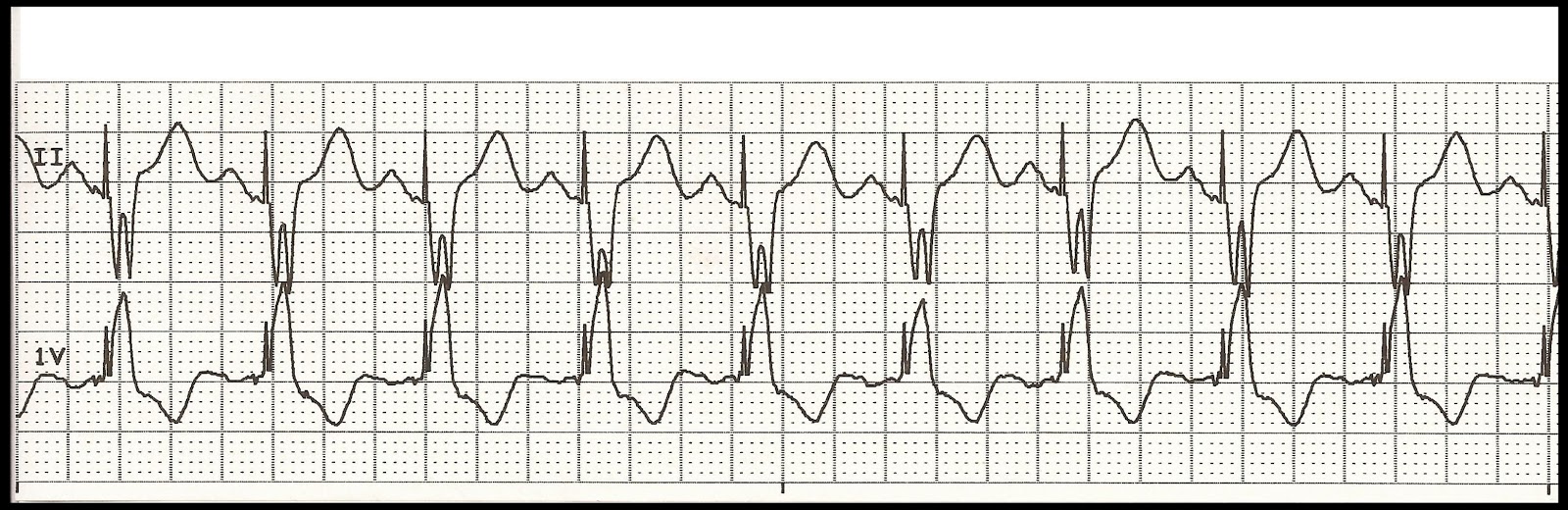 EKG Rhythm Strip Quiz 100: Paced rhythms