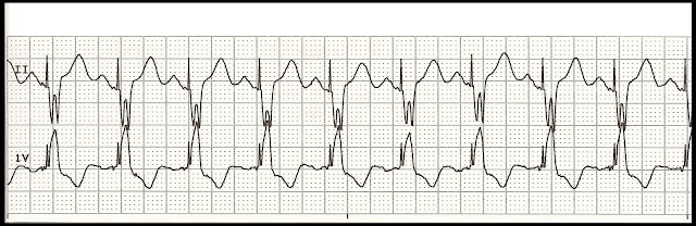 EKG Rhythm Strip Quiz 100: Paced rhythms