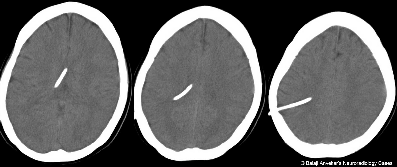 Dr Balaji Anvekar FRCR: CSF shunt imaging