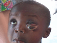 Anthrax - Acute and Highly Contagious Disease - Ain Health