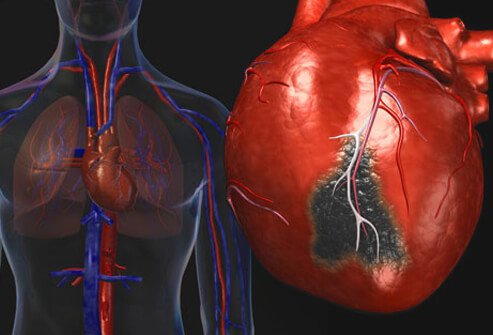 Ce que tu cherche : Maladie cardiaque: Causes d'une crise cardiaque