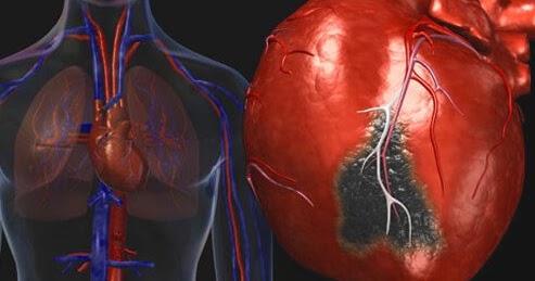 Ce que tu cherche : Maladie cardiaque: Causes d'une crise cardiaque