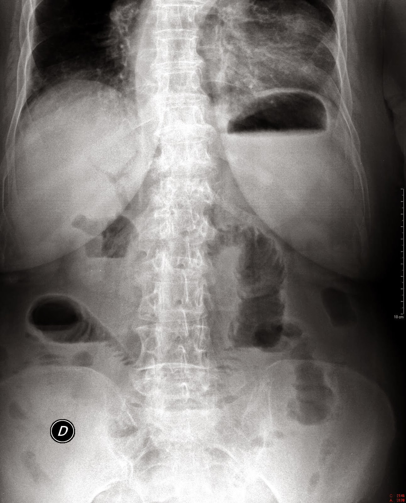 Radiodiagnóstico HUValme: CASO Nº 5: ABDOMEN
