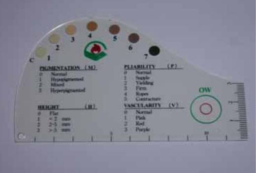 傷口大師: 溫哥華疤痕評量尺計分標準表修改版(MVSS)