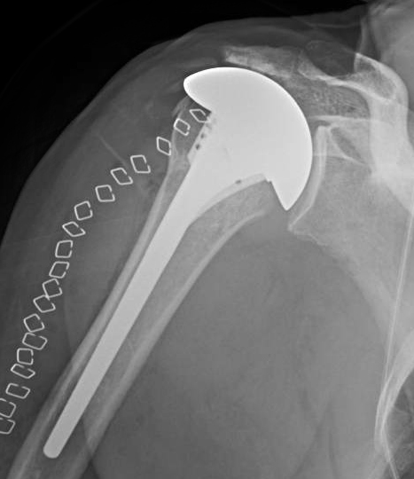 UW Shoulder and Elbow Academy: Cuff tear arthropathy treatment with a ...