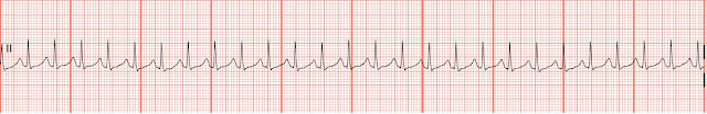 Float Nurse: EKG Rhythm Strip Quiz 39