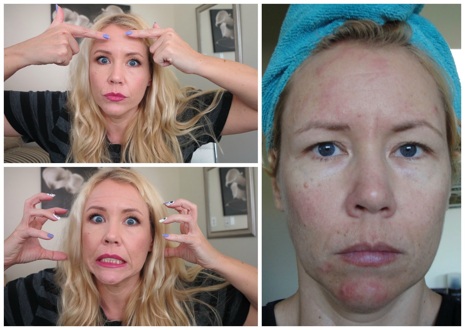 25 YEARS OF SKIN PICKING AND TIPS TO AVOID IT: DERMATILLOMANIA