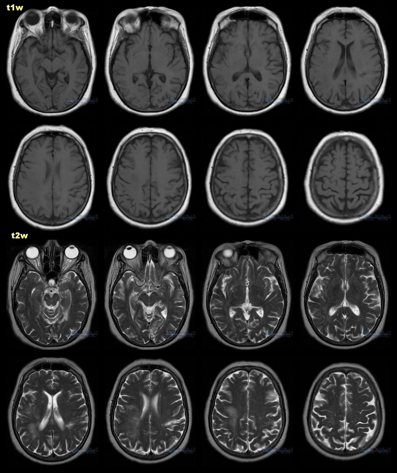 Radiology Archives: Υποξύ Ισχαιμικό Έμφρακτο (Luxury Perfusion)