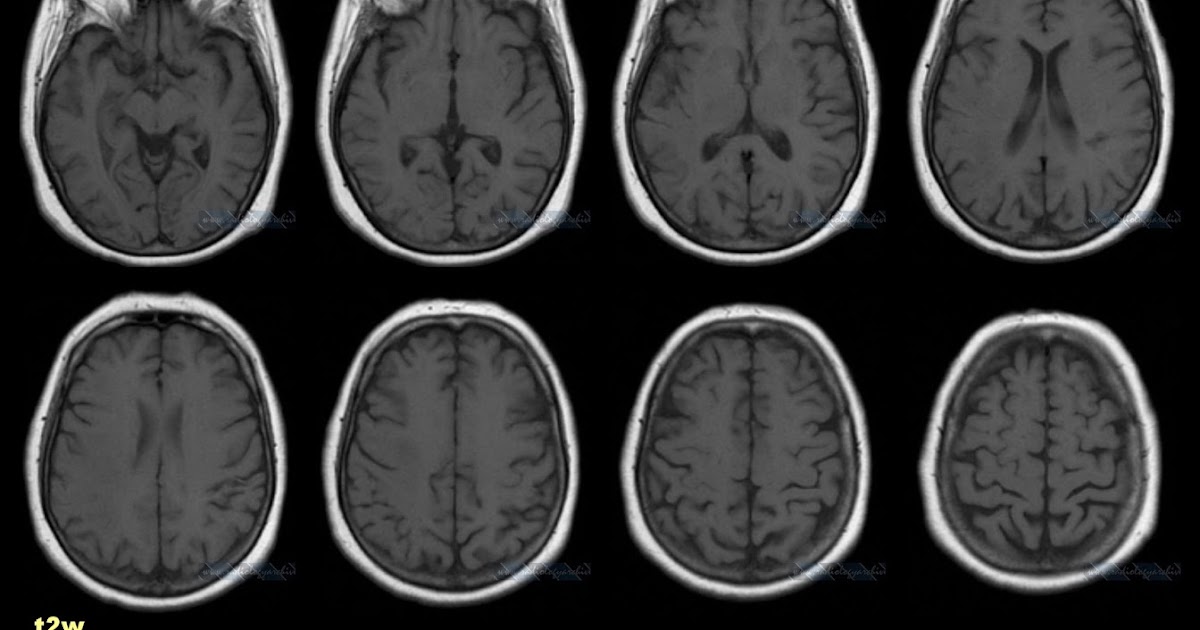 Radiology Archives: Υποξύ Ισχαιμικό Έμφρακτο (Luxury Perfusion)