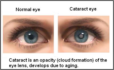 Cataracts - Types, Symptoms, And All You Need To Know
