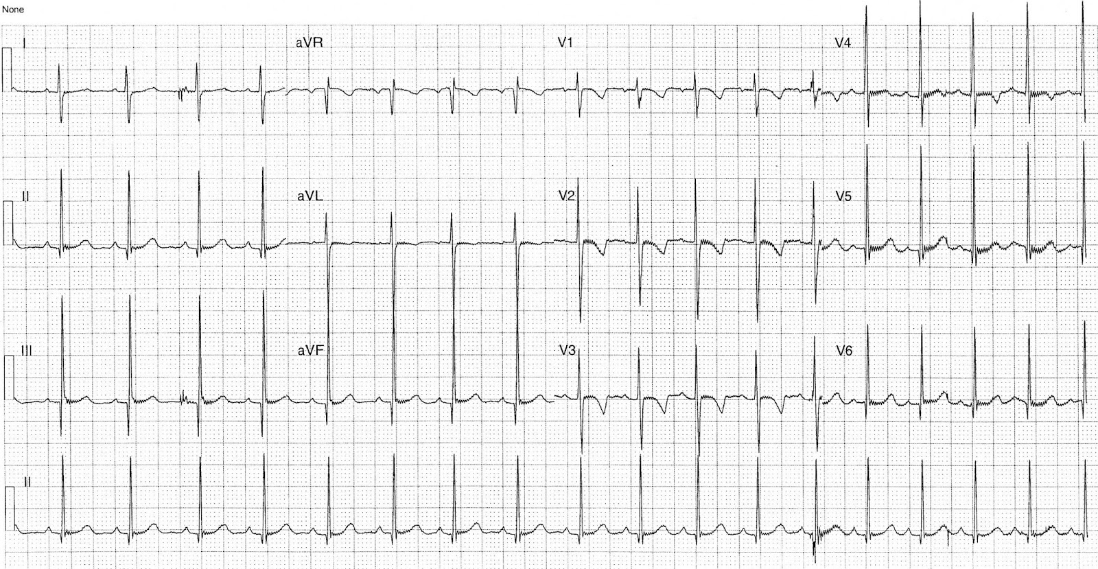 ECG of the Week: ECG of the Week - 9th April 2018 - Interpretation