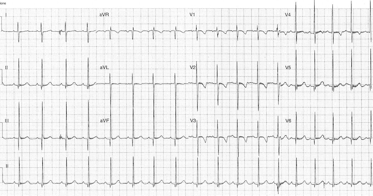 ECG of the Week: ECG of the Week - 9th April 2018 - Interpretation