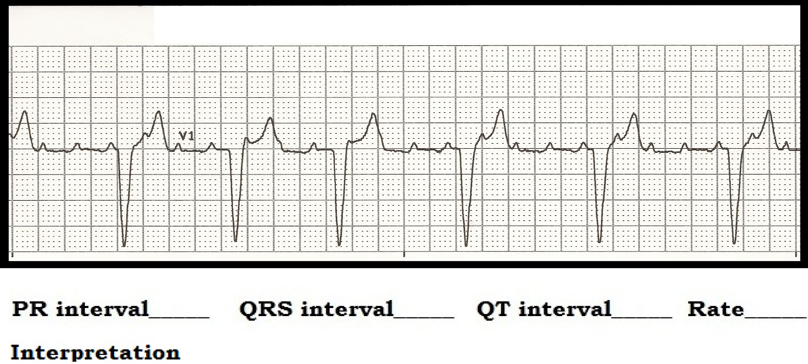 ECG Rhythm Strip Quiz 89: Interval measurements