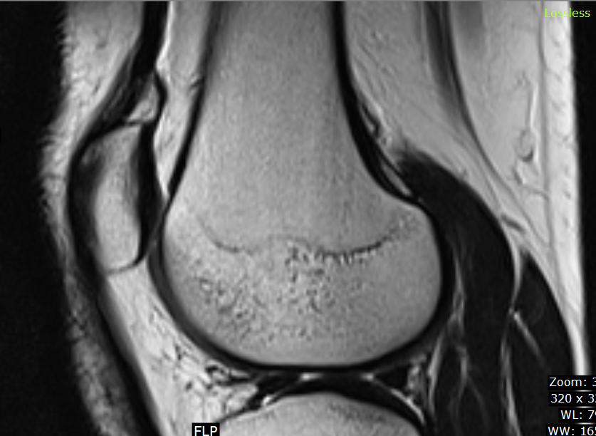 Suprapatellar Plica - Sumer's Radiology Blog