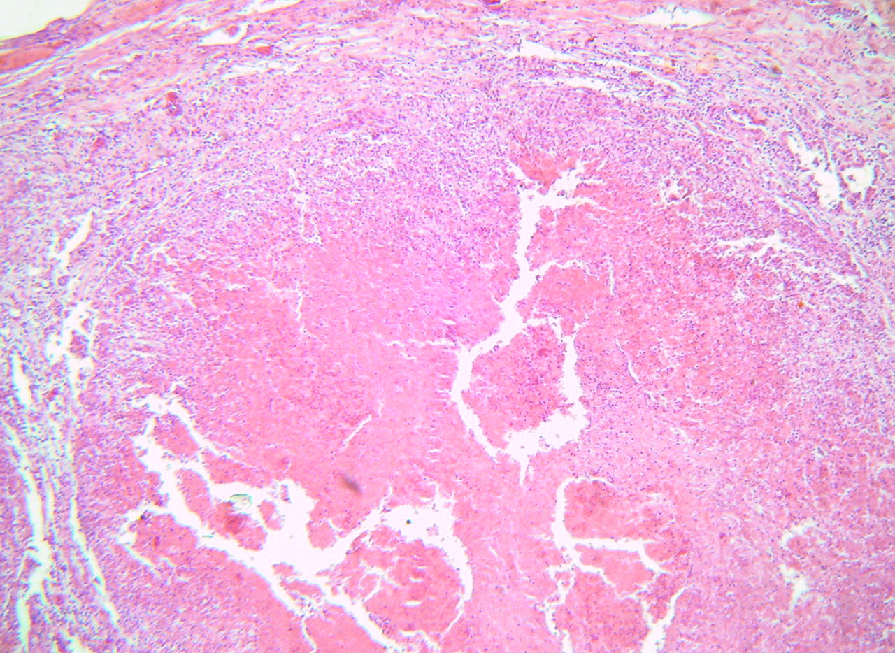 necrose caseosa - wood scribd braxin