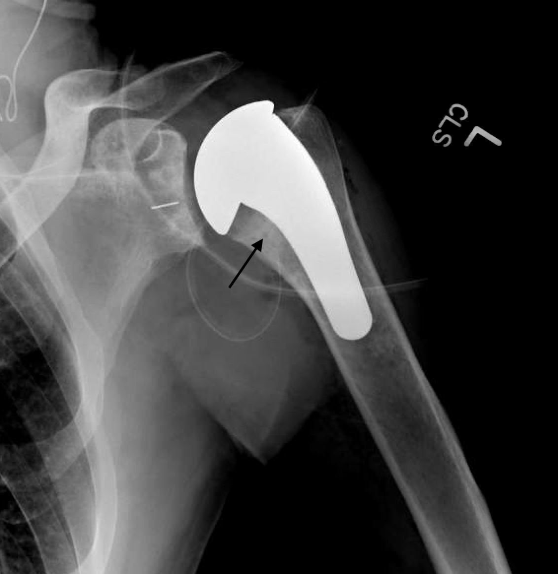 Shoulder and Elbow Surgery: Impaction autografting of the medial calcar ...