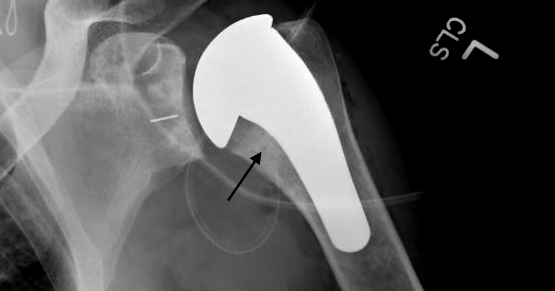 Shoulder and Elbow Surgery: Impaction autografting of the medial calcar ...