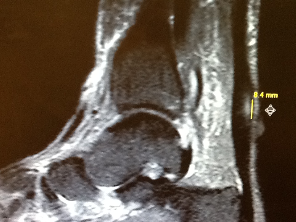 Foot and Ankle Problems By Dr. Richard Blake: Partial Rupture Achilles ...