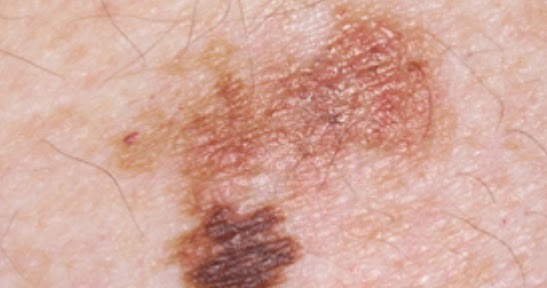 Pictures Of Skin Cancer Scalp Skin Cancer