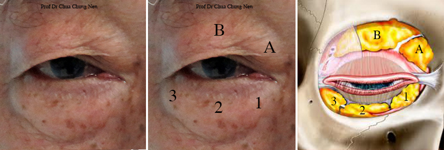 Eyelid Surgery by Prof Dr CN CHUA 蔡鐘能: 2015
