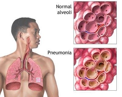 Apa itu penyakit radang paru-paru (pneumonia) atau lebih di kenali ...