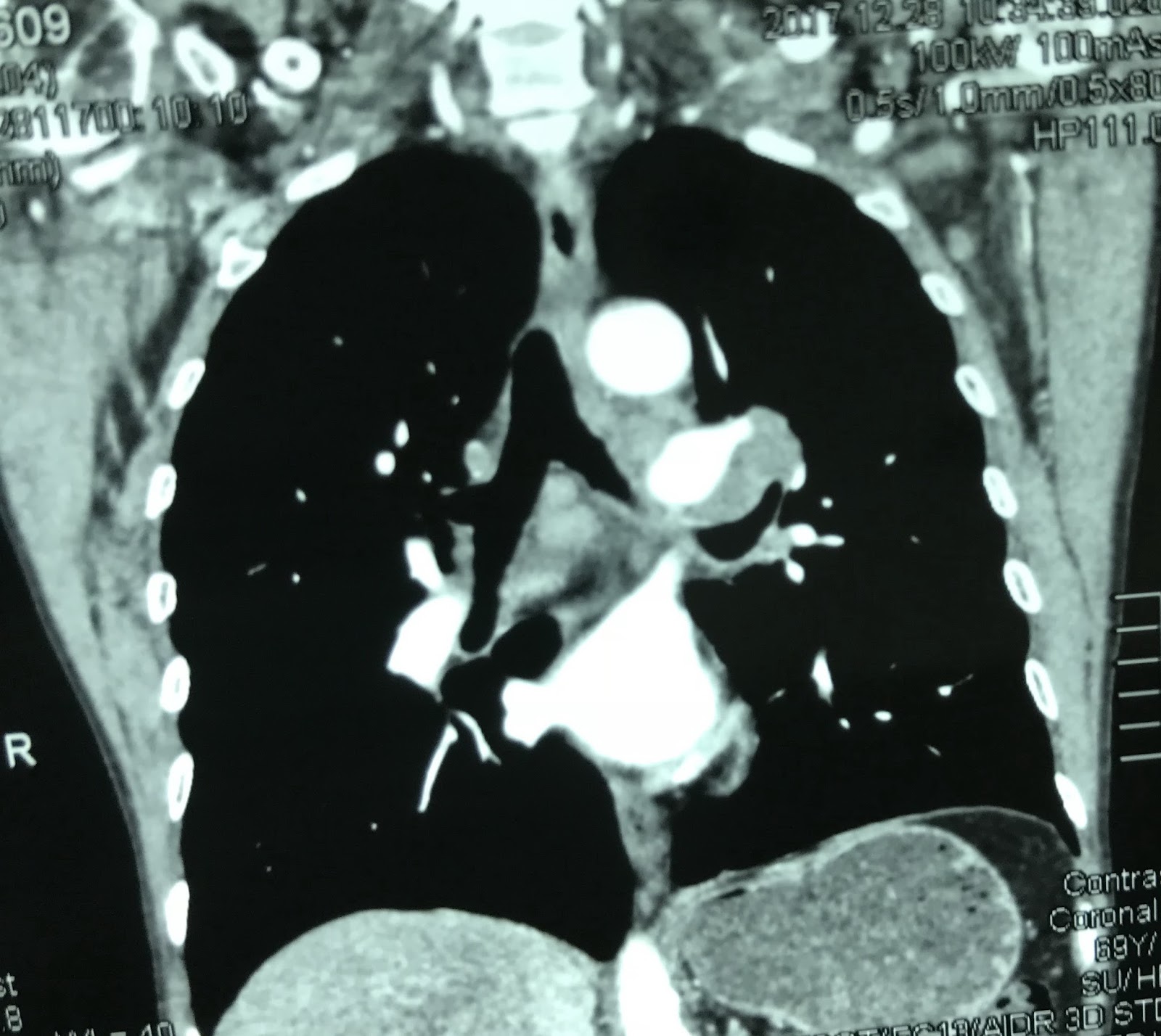 VIETNAMESE MEDIC ULTRASOUND: CASE 470: TROISIER-VIRCHOW NODES, Dr PHAN ...