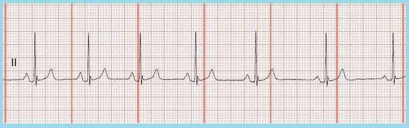 Practice EKG Rhythm Strips 194