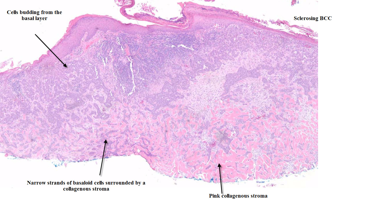 Dermpath Made Simple - Neoplastic: Basal Cell Carcinoma