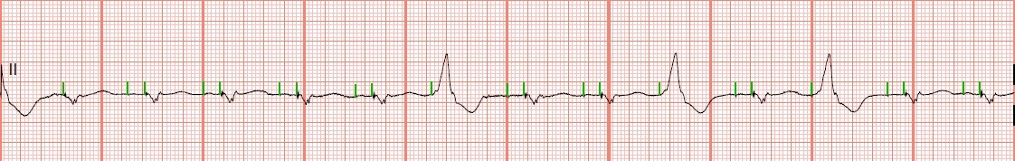 EKG Rhythm Strip Quiz 35