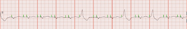 EKG Rhythm Strip Quiz 35