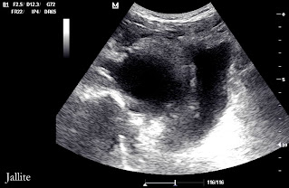 Absceso Pelvico en Hombre