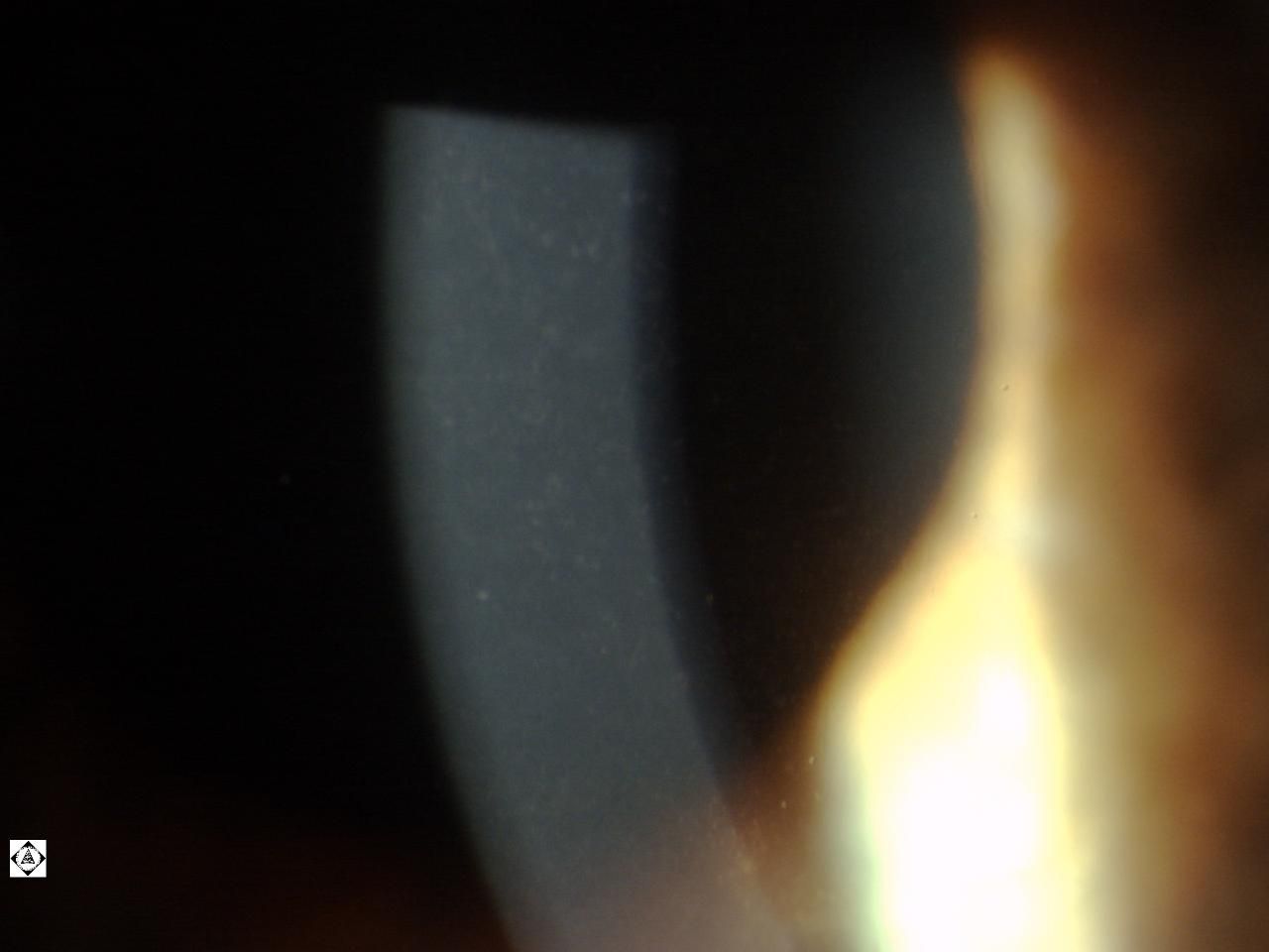 Sonoran Desert Eye Center: POSTERIOR POLYMORPHOUS CORNEAL DYSTROPHY