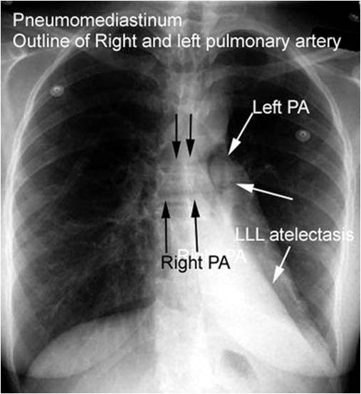 RADIOLOGY IMAGE SPOTTERS: Left lower collapse + pneumo