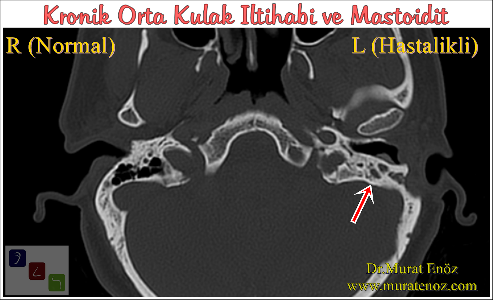 Kronik Orta Kulak İltihabı ve Mastoidit