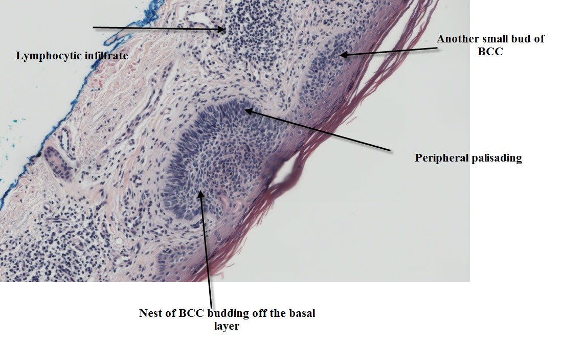 Dermpath Made Simple - Neoplastic: Basal Cell Carcinoma