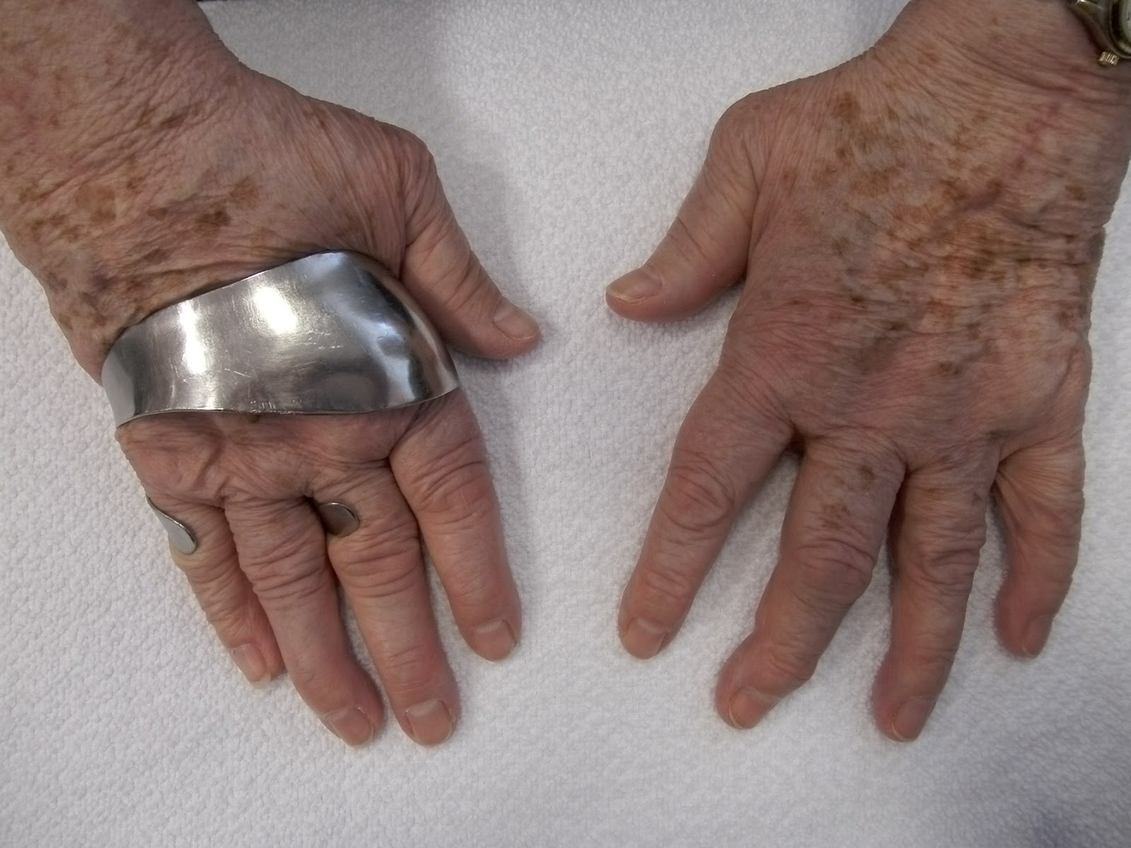 Rheumatologe: Malingerer with erosive Rheumatoid Arthritis