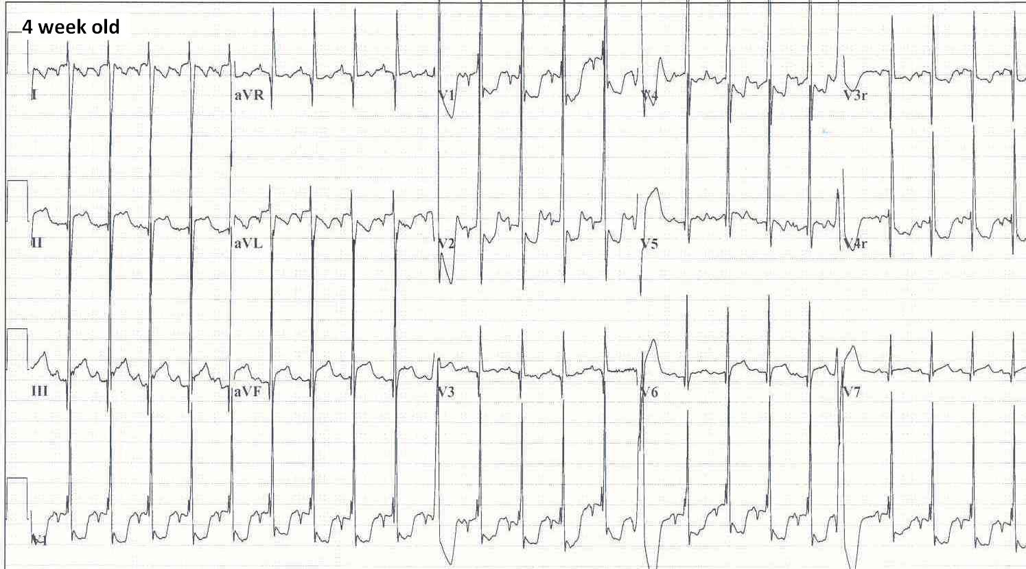 PediCardiology Quiz: Quiz #15: 12-lead EKG - Inverted P
