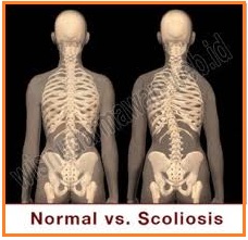 BIOLOGI GONZAGA: GANGGUAN TULANG-OTOT DAN PERGELANGAN