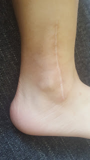 My Broken Ankle =(: 4 years 5 months - Surgery Scar