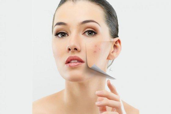 ¿CUÁL ES EL TRATAMIENTO DEL ACNÉ LEVE DE LA MUJER ADULTA?