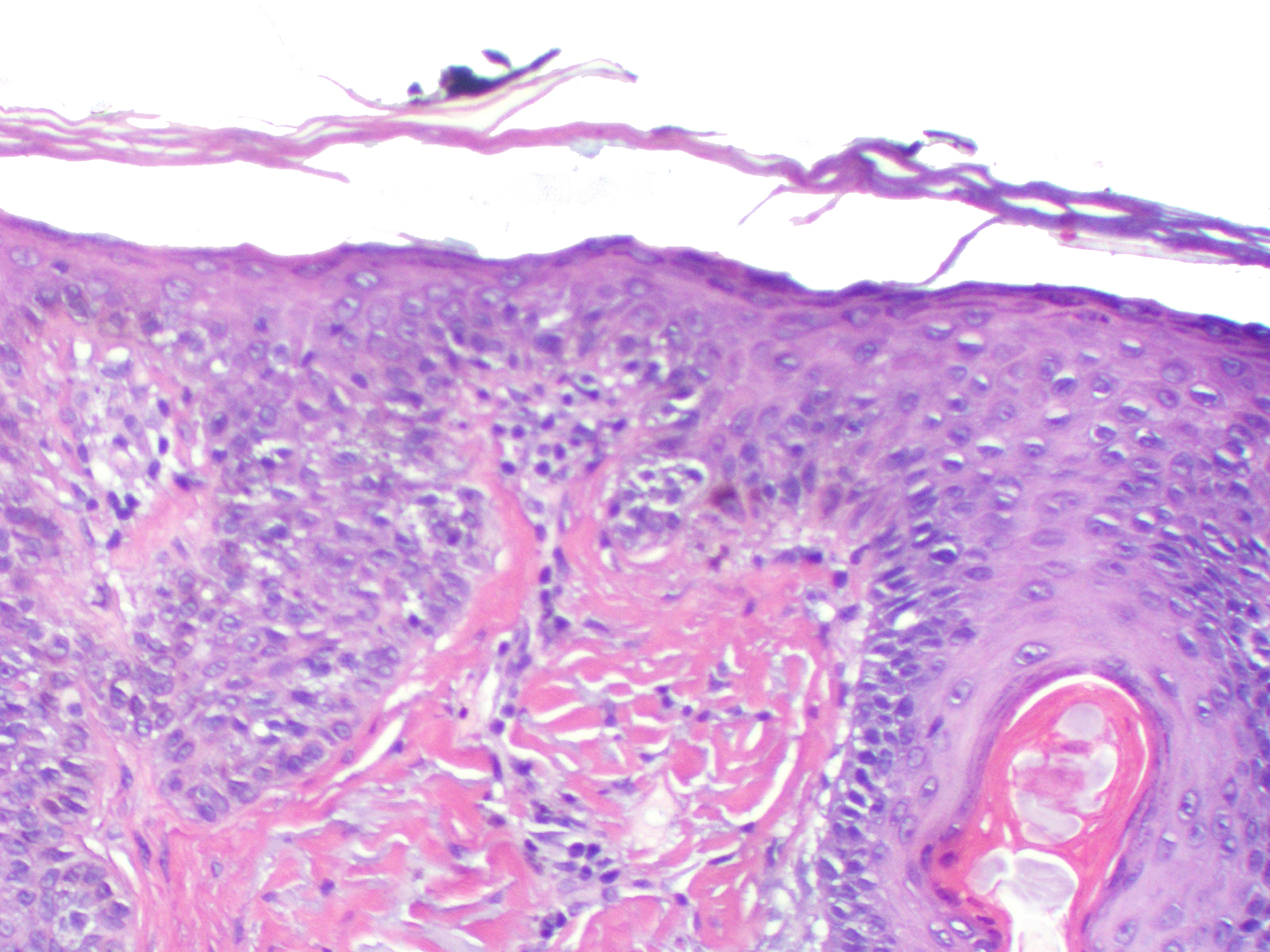 VIRTUAL GRAND ROUNDS IN DERMATOLOGY 2.0: Whose Nose Needs Mohs?