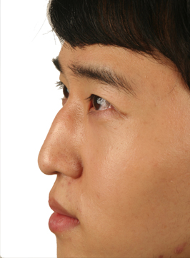 ID Hospital Korea: [ID hospital review] Male nose surgery, hawk nose ...