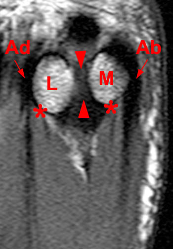 MRI Musculo-Skeletal Section: Turf toe.