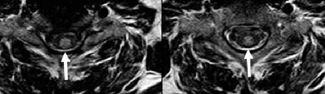 NeuroAnatomía Dr. William Ganem: Mielitis transversa asociada a ...