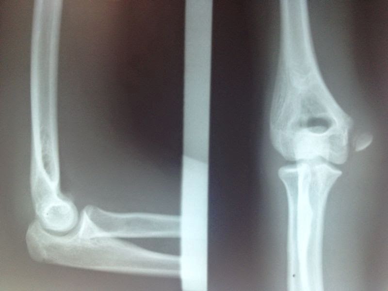 Ortopedia y Traumatología Pediátrica: Discusión entre pares / Femenina ...